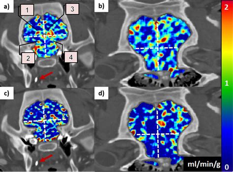 Perfusion Color Maps Generated By The Two Volume Ct Perfusion Technique