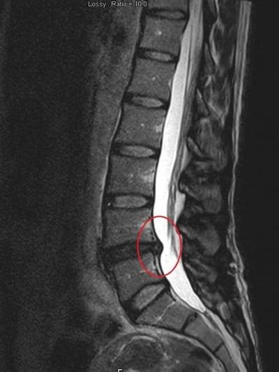 Tratamiento De La Hernia Discal L5 Y S1 Izquierda O Quinta Lumbar Y Sacro