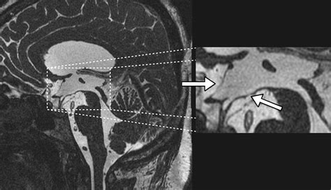 Functional Gait Outcomes For Idiopathic Normal Pressure Hydrocephalus