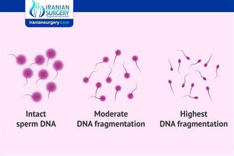 Sperm Dna Fragmentation Test Procedure Iranian Surgery
