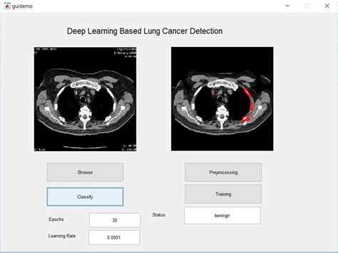 Lung Cancer Detection Using Deep Learning