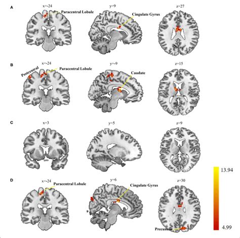 Group Differences In Seed Based Functional Connectivity Fc A
