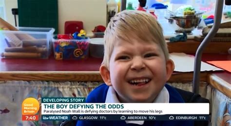 El Extraordinario Caso De Noah El Niño Que Nació Con Un 2 De Cerebro