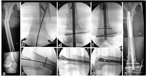 A Segmental Closed Fracture Of The Right Femur In A 33 Year Old