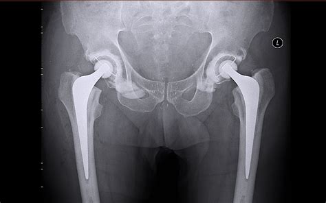 better sex after hip surgery the new york times