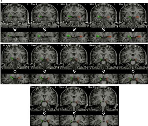 A Right Green And Left Red Segmentations Of Piriform Cortex In