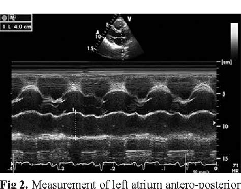 Figure 2 From Left Atrium Function Assessment By Echocardiography