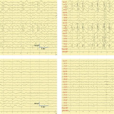 A Electroencephalography Eeg At The Age Of 4 Years Showing Sharp