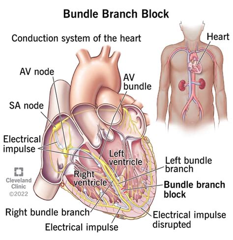 Left Anterior Fascicular Block Causes And Treatment