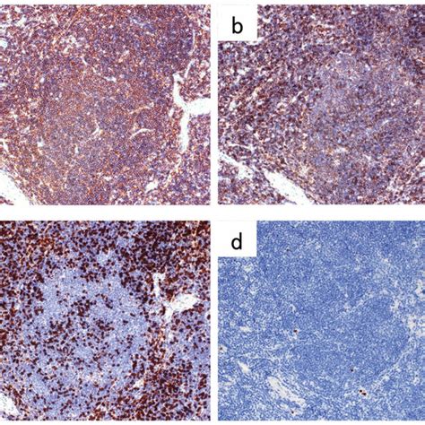On Immunoperoxidase Staining Cells Show Positive Staining For Cd20 A