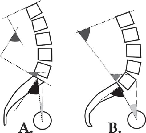 Low A And Great B Value Of Pelvic Incidence And Sagittal Lumbar