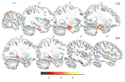 Results Of The Voxel Based Morphometry Analysis Red To Yellow Patches