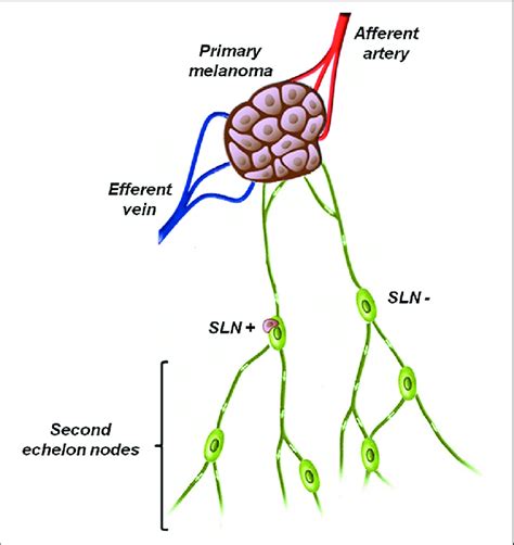 Schematic Representation Of The Sentinel Lymph Node Sln Concept