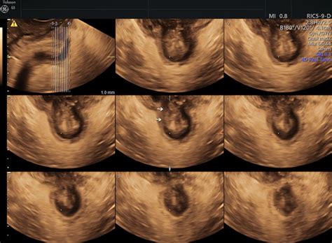 The Role Of 3d Ultrasound In Pelvic Reconstruction Surgery Empowered