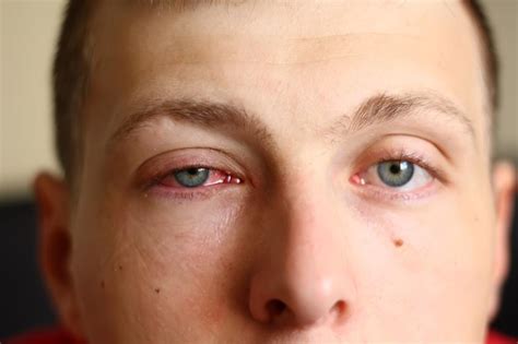 Por Qué Me Lloran Los Ojos Y Me Pican Y Cómo Aliviarlos
