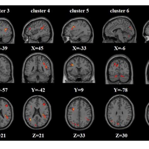 Positive Correlation Between The Alff And Reho Of The Abnormal Brain