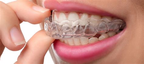 Teeth Grinding Bruxism Causes And Treatments Clove Dental
