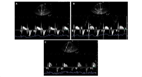 Pulsed Wave Tissue Doppler Imaging Pwtdi Mode Images Obtained From