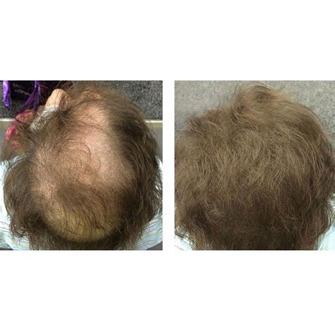 Infinity Hair Fibers For Thinning Or Balding Hair For Men And Women 14