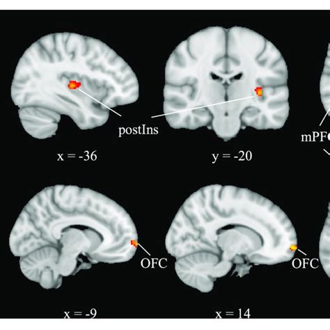 Increased Right Amygdala Based Functional Connectivity Following