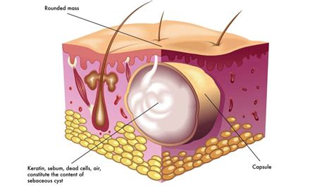 Sebaceous Cyst Removal Excision Gold Coast Skin Clinic Robina