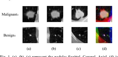 Figure 1 From Classification Of Benign And Malignant Pulmonary Nodules