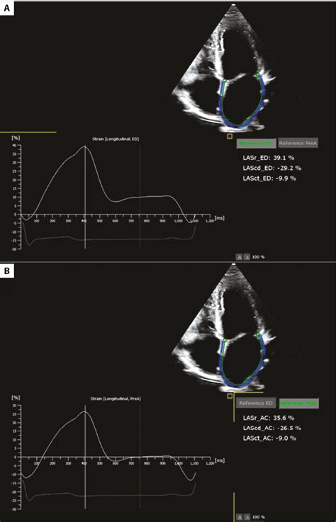 Left Atrial Strain — A Current Clinical Perspective Kupczyńska