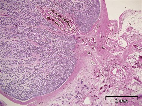 Polyorchidism A Case Report And Classification Journal Of Pediatric