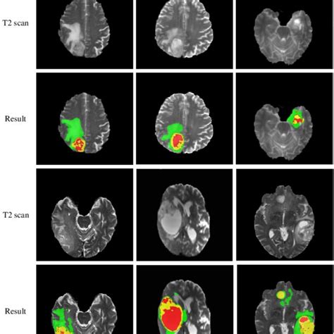 Pdf H2nf Net For Brain Tumor Segmentation Using Multimodal Mr Imaging