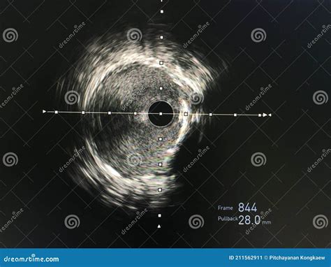 Intravascular Ultrasound Imaging Ivus Stock Image Image Of Clot