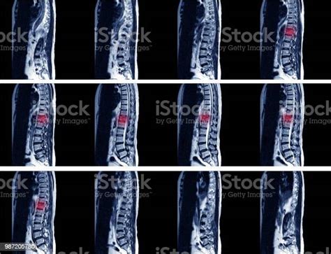 Imagen De Resonancia Magnética De Columna Vertebral Humana Con Lordosis
