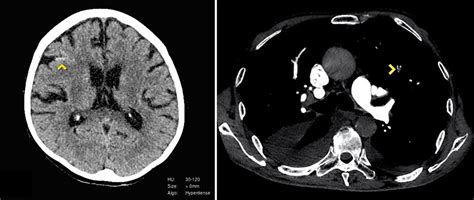Performance Of An Artificial Intelligence Tool With Real Time Clinical