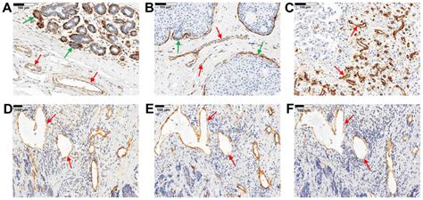 Nestin Positive Microvessel Density Is An Independent Prognostic Factor