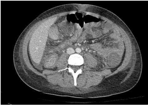 Case Report Of A Peculiar Presentation Of Hereditary Complement