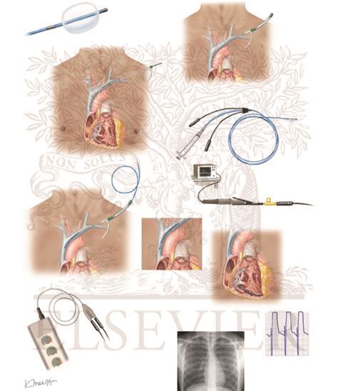 Transvenous Pacemaker Placement