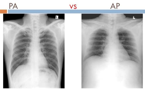 Interpreting A Chest X Ray Stepwards