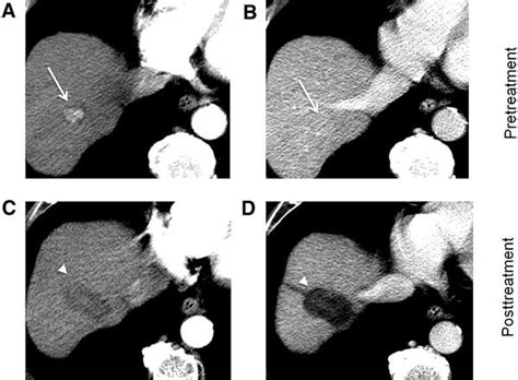 Hepatocellular Carcinoma Hcc Treated With Radiofrequency Ablation A