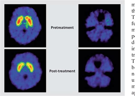 Serotonin Modulation Of Striatal Dopamine Concentrations Measured With