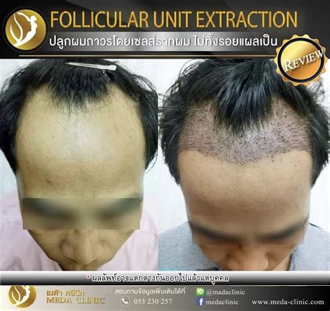 รายการ 101 ภาพพื้นหลัง Apex ปลูกผม ใหม่ที่สุด