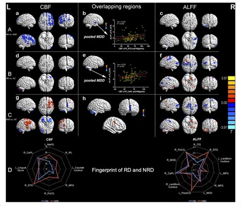 Inter Group Regional Differences In Cbf And Alff And Positive
