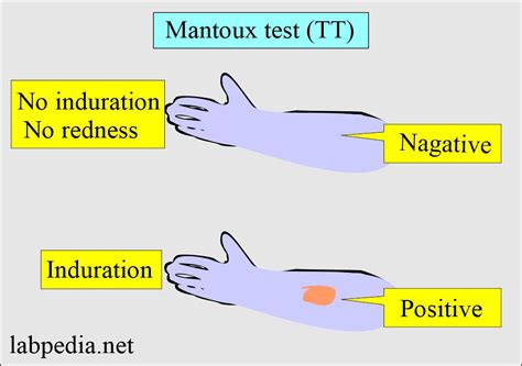 Mycobacterium Tuberculosis Part Mantoux Test Tt 58 Off