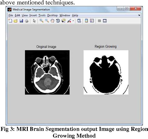 figure 3 from algorithm for medical image segmentation using hmrf