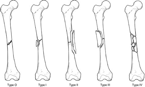 Describe The Types Of Femoral Shaft Fractures Jayvon Has Russo