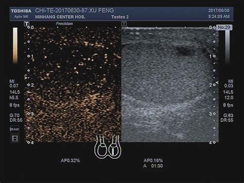 The Ceus Manifestation Of A Testicular Hematoma No Enhancement During
