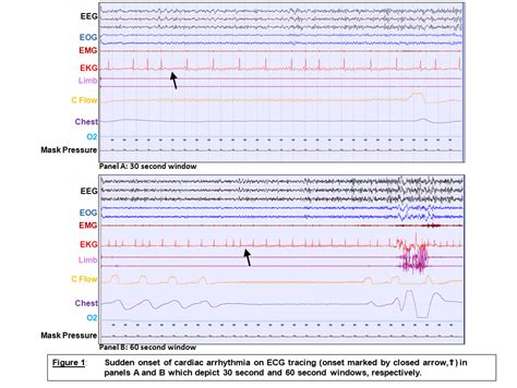 Central Sleep Apnea Induced Acute Cardiac Arrhythmia