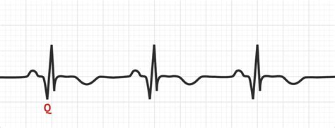 The Qrs Complex Ecg Basics Medschool