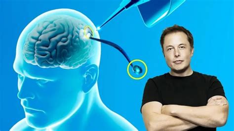 Elon Musk Anuncia Exitoso Implante De Chips Cerebrales De Neuralink En