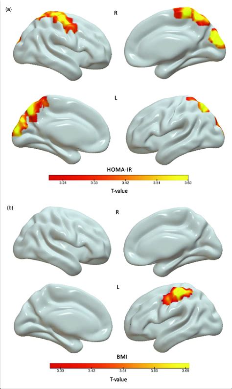 voxel wise regression analysis of the association between [ 11