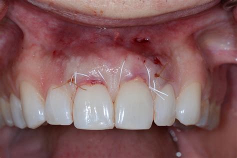 I Got A Gum Transplant So I Could Have A Younger Smile Vice