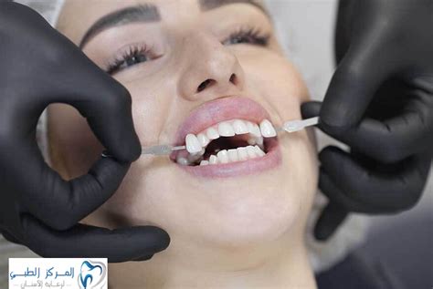 Cosmetic Dental Veneers And The Most Famous Types That Can Be Installed
